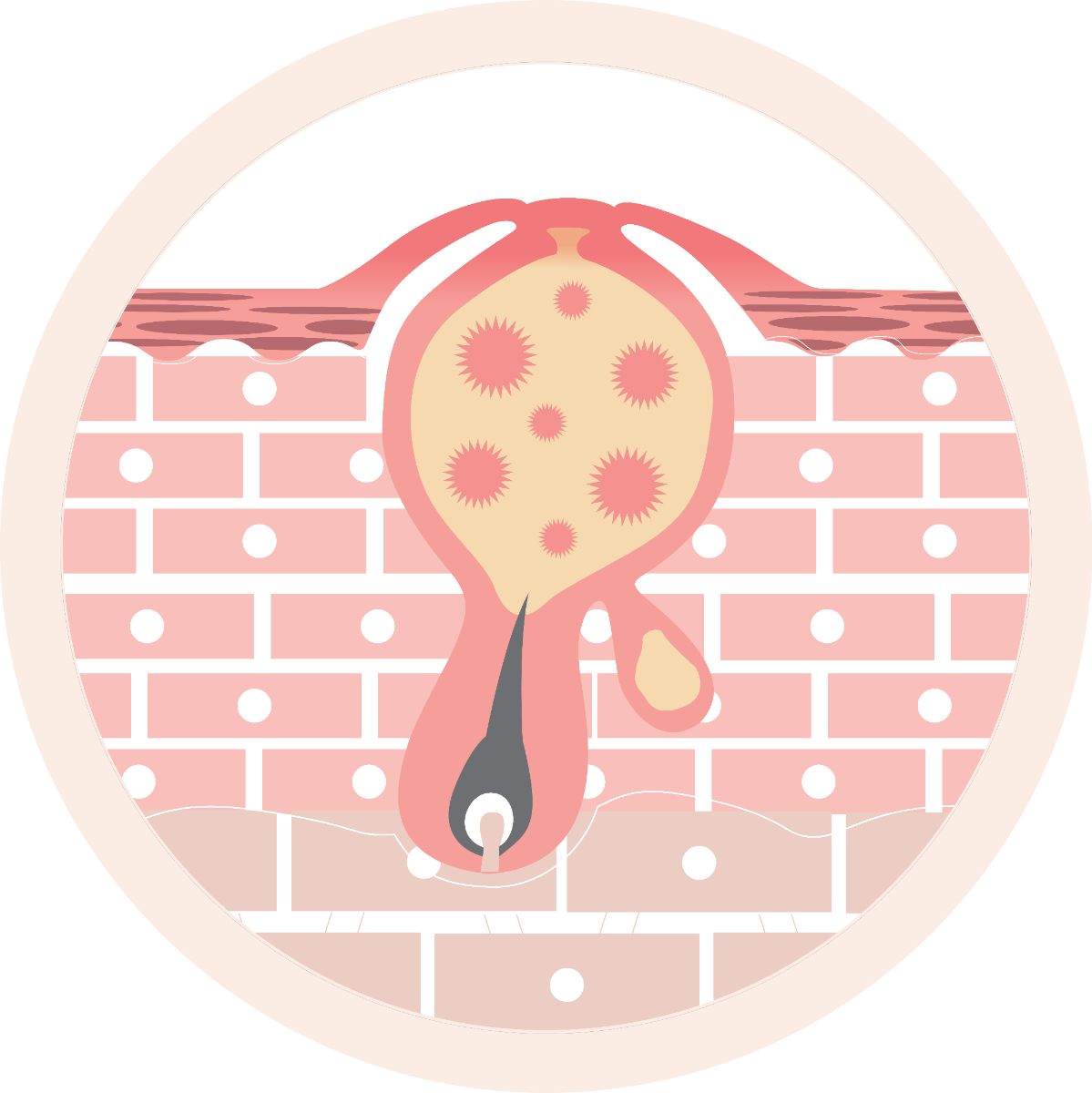 acne tips – Marini SkinSolutions